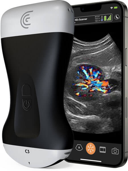 Best Pocket Ultrasound - Best Handheld Ultrasound